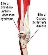 Sinding Larsen Johansson Syndroom | Fysiotherapie4all