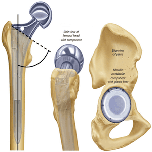 Heupprothese Oefeningen En Behandeling | Fysiotherapie4all