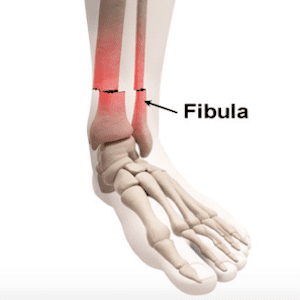 Kuitbeen Breuk Oefeningen En Behandeling | Fysiotherapie4all