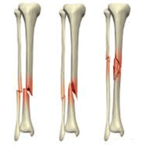 Scheenbeenbreuk Oefeningen En Behandeling| Fysiotherapie4all