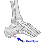 Hielspoor Oefeningen En Behandeling | Fysiotherapie4all