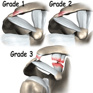 AC-Gewricht Luxatie Behandelen? | Fysiotherapie4all