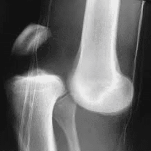 Luxatie Van De Knie Oefeningen En Behandeling | Fysiotherapie4all