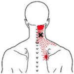 Symptomen Van Triggerpoints Oefeningen En Behandeling| Fysiotherapie4all