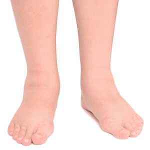 Oedeem Oefeningen En Behandeling | Fysiotherapie4all