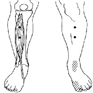 Welke Spieren Kunnen Scheenbeenklachten Veroorzaken? | Fysiotherapie4all