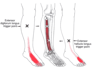 Welke Spieren Kunnen Scheenbeenklachten Veroorzaken? | Fysiotherapie4all
