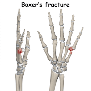 Boxer Fractuur Oefeningen En Behandeling | Fysiotherapie4all
