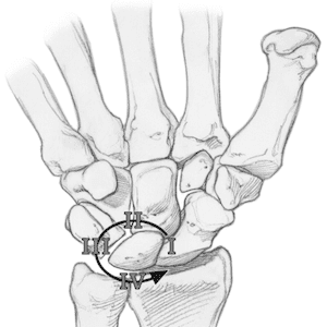 DISI-deformiteit Oefeningen En Behandeling| Fysiotherapie4all