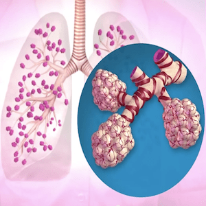 Longemfyseem Oefeningen En Behandeling | Fysiotherapie4all