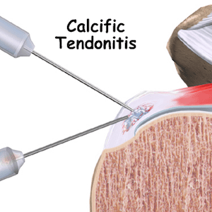 Verkalking In De Schouder Oefeningen En Behandeling | Fysiotherapie4all