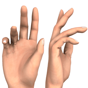 Contractuur Oefeningen En Behandeling | Fysiotherapie4all