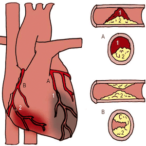 Hartinfarct Symptomen En Behandeling | Fysiotherapie4all