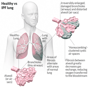 Longfibrose Oefeningen En Behandeling | Fysiotherapie4all
