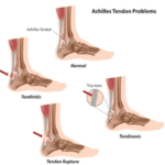 Achillespees Ontsteking: Alles Over Achillespeespijn | Fysiotherapie4all