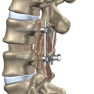 Spondylodese Oefeningen En Behandeling | Fysiotherapie4all
