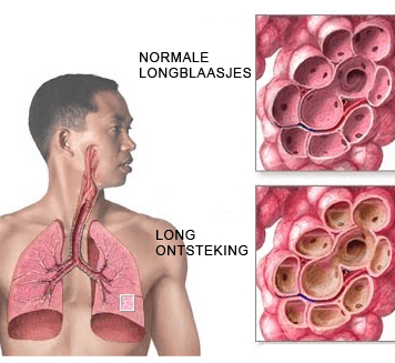 Longontsteking Oefeningen En Behandeling| Fysiotherapie4all