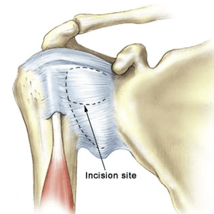 Capsular Shift Oefeningen En Behandeling | Fysiotherapie4all