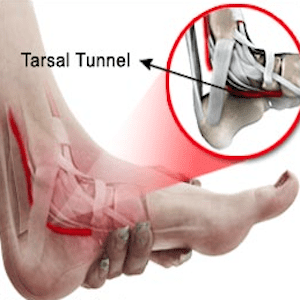 Tarsaal Tunnel Syndroom Oefeningen En Behandeling| Fysiotherapie4all