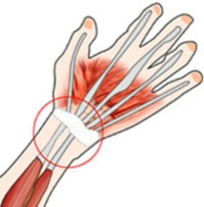 Tennisblessures, De Meest Voorkomende Blessures En Hoe Ze Te Voorkomen ...