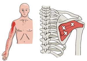 Infraspinatus Spier Oefeningen En Behandeling - Pijnvrij?