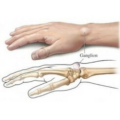 Polscyste Oefeningen En Behandeling| Fysiotherapie4all