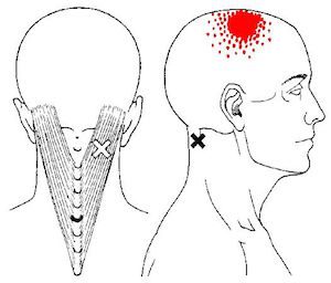 Splenius Capitis Oefeningen En Behandeling | Fysiotherapie4all