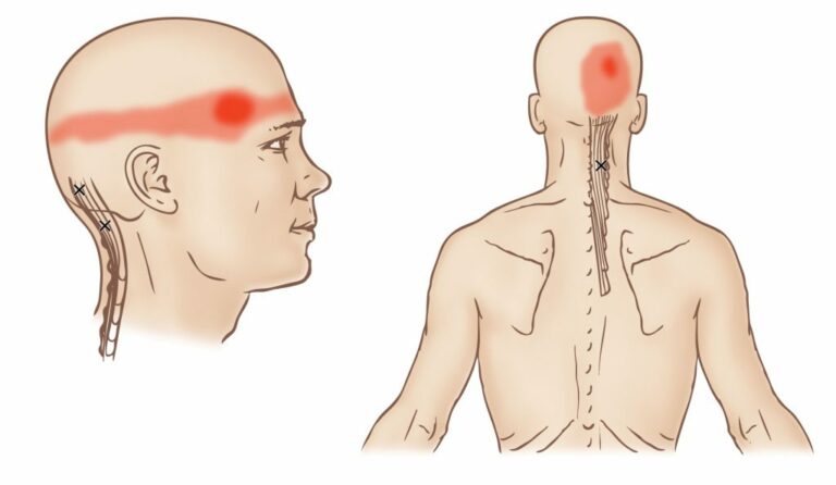 Splenius Capitis Oefeningen En Behandeling | Fysiotherapie4all