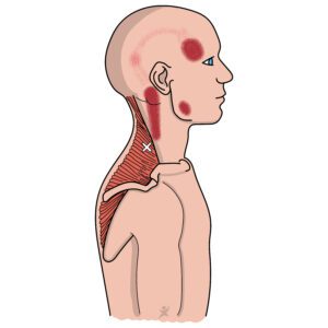 Nekpijn Door Thuiswerken Verhelpen? | Fysiotherapie4all
