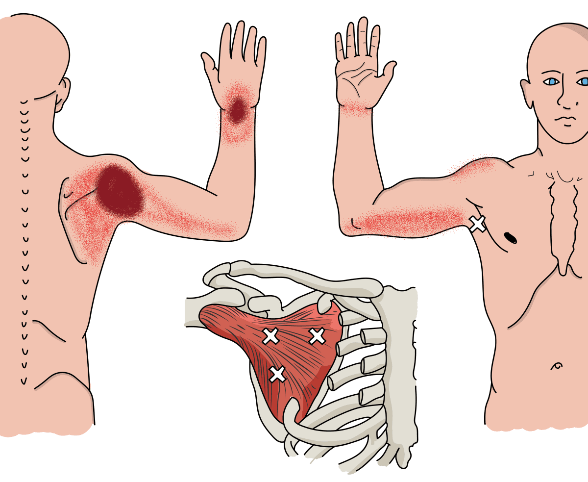 Ontdek Hoe Jouw Spieren Werken! | Fysiotherapie4all