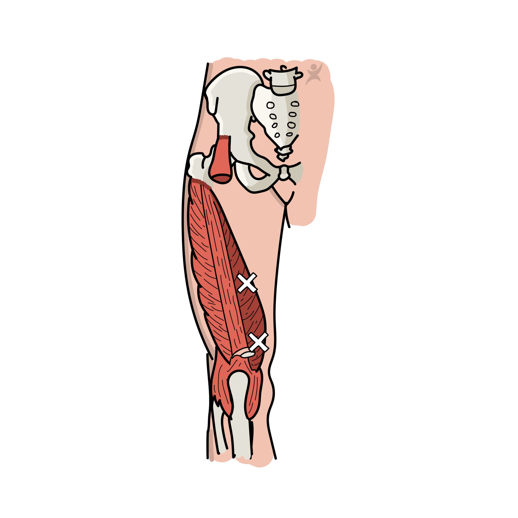 Triggerpoints En Heupklachten Verhelpen! | Fysiotherapie4all