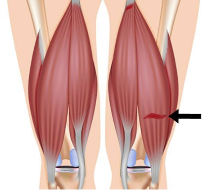 Wat Te Doen Bij Een Hamstringblessure? | Fysiotherapie4all